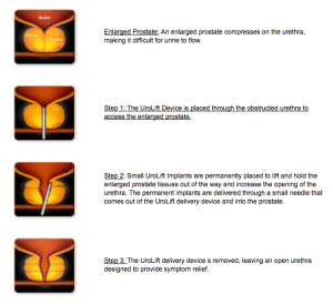 UroLift for BPH | Arkansas Urology Center of Excellence